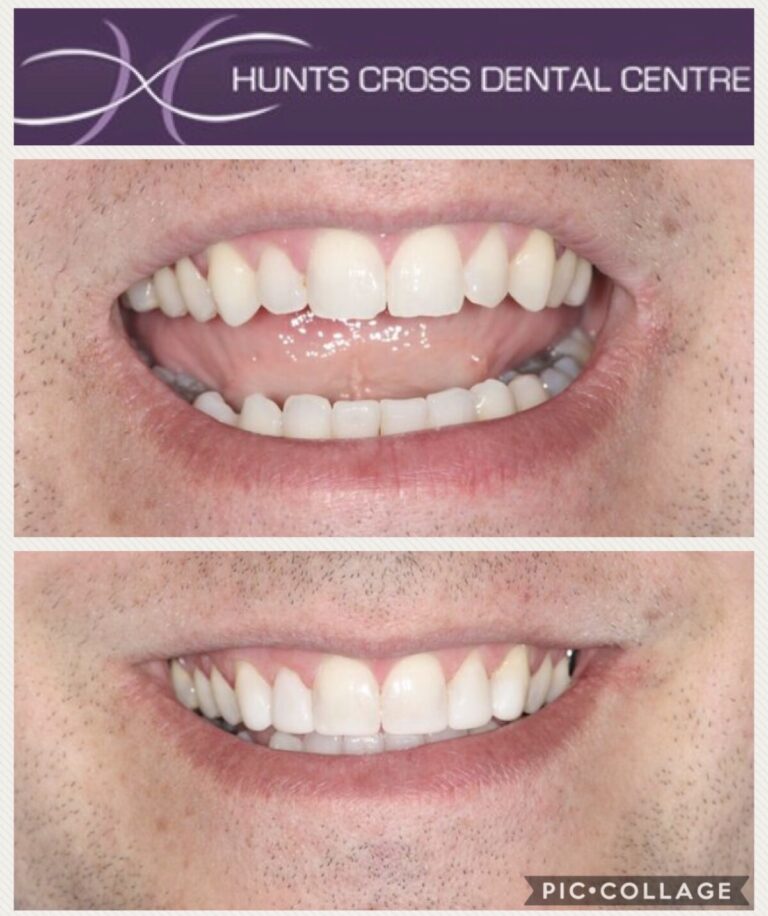 Quick, Straight Teeth With Composite Bonding - Hunts Cross Dental ...